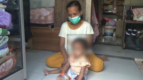 Derita Balita Berkelamin Ganda di Surabaya, Kurang Gizi sehingga Tidak ...