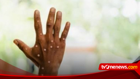 IDI Minta Dokter Waspadai Gejala Monkeypox pada Pasien