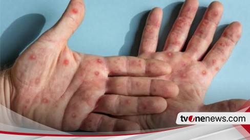 Waspada Gejala Awal Monkeypox: Ruam, Demam, dan Nyeri? Ini Langkah ...